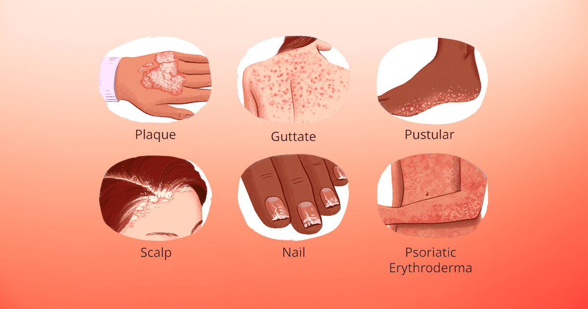 What Is Psoriasis and How to Get Rid of It