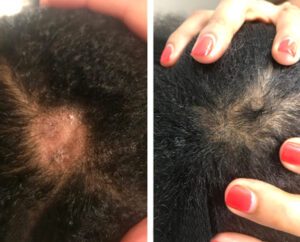 How to Regrow Hair on Bald Spots Fast | Proven Tips & Tricks