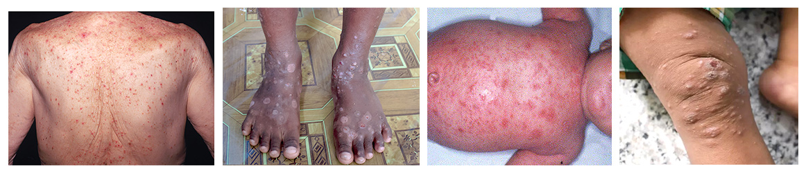 Scabies Treatment in Chennai
