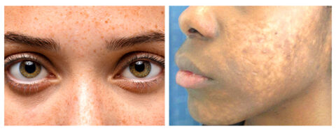 Skin Pigmentation Treatment in Chennai